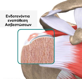 Ασβεστοποιος Τενοντιτιδα | Δρ. Νίκος Παπαλουκάς, Ορθοπαιδικός Χειρούργος