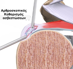 Ασβεστοποιος Τενοντιτιδα | Δρ. Νίκος Παπαλουκάς, Ορθοπαιδικός Χειρούργος