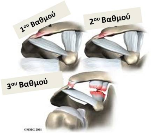 Εξαρθρημα της Ακρωμιοκλειδικης αρθρωσης | Δρ. Νίκος Παπαλουκάς ...