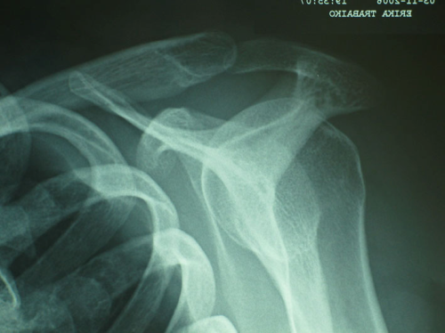 Συνδρομο Υπακρωμιακης Προστριβης | Δρ. Νίκος Παπαλουκάς, Ορθοπαιδικός ...