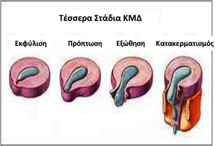 Δισκοπαθεια - Κηλη Μεσοσπονδυλιου Δισκου (ΚΜΔ) | Δρ. Νίκος Παπαλουκάς ...